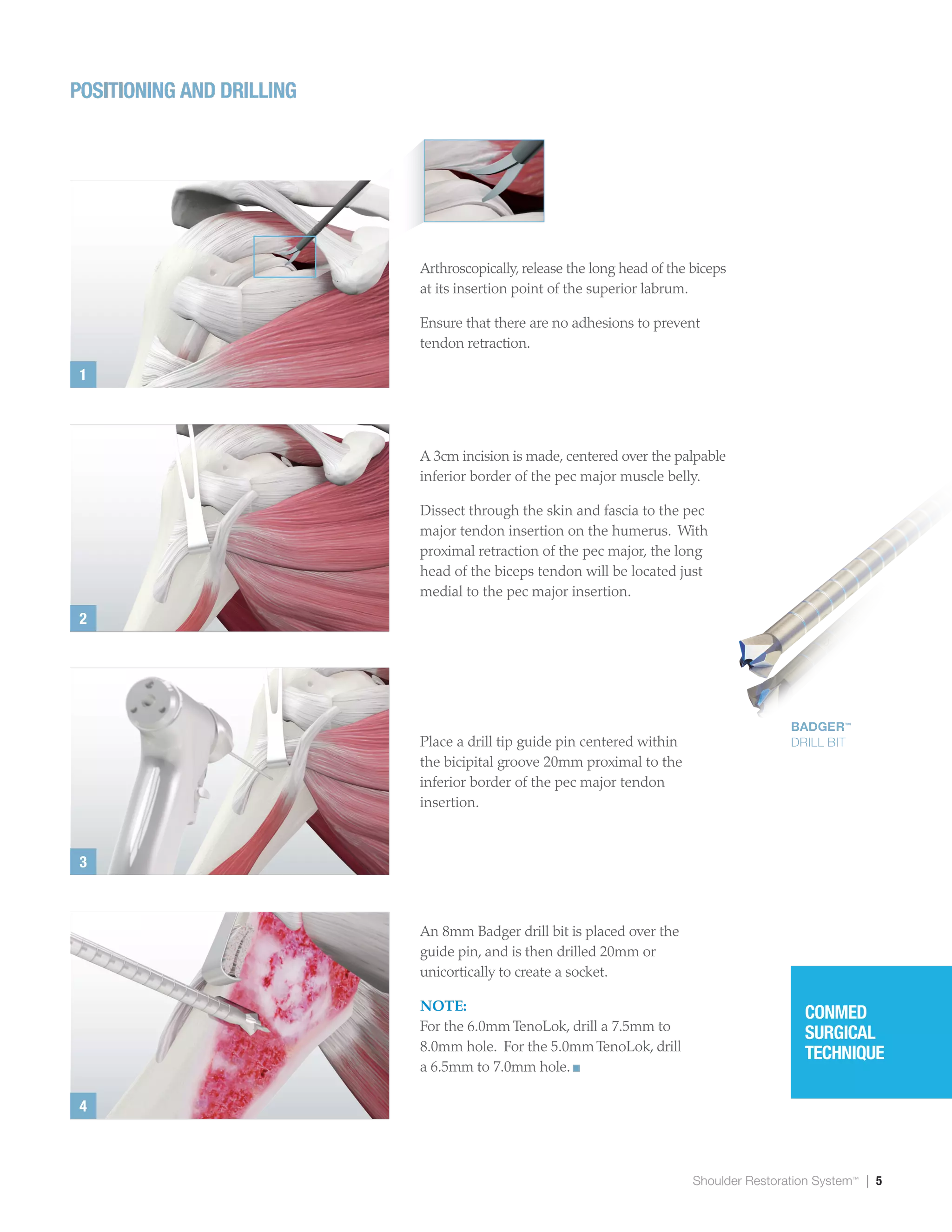 Brad Bernardini, MD: Sub-Pectoralis Biceps Tenodesis Using the TenoLok ...