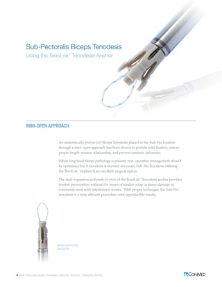 Brad Bernardini, MD: Sub-Pectoralis Biceps Tenodesis Using the TenoLok ...