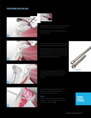 Brad Bernardini, MD: Sub-Pectoralis Biceps Tenodesis Using the TenoLok ...