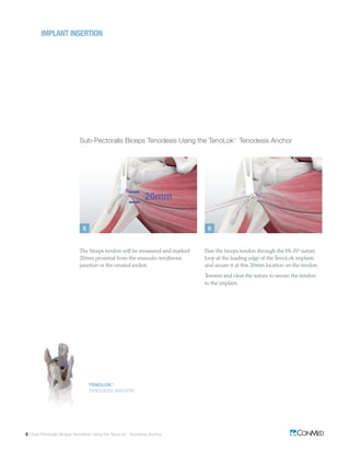 Brad Bernardini, MD: Sub-Pectoralis Biceps Tenodesis Using the TenoLok ...