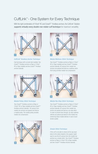 CuffLink™ Double-Row Solution - Less Abrasion, Less Unplanned Tension | PDF