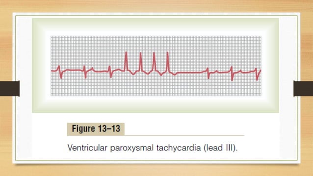 M2 PBL 3 Heart blocks hrheheheheheehge.pptx