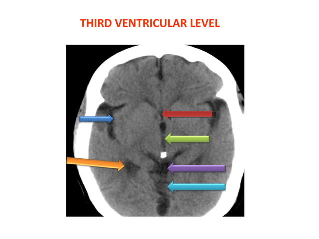 CT Scan - Basics | PPT