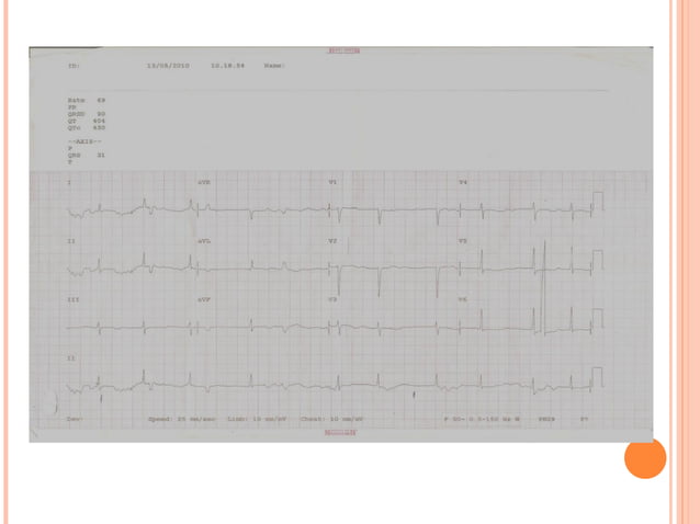 ECG: New onset AF with slow ventricular response | PPT | Heart and ...