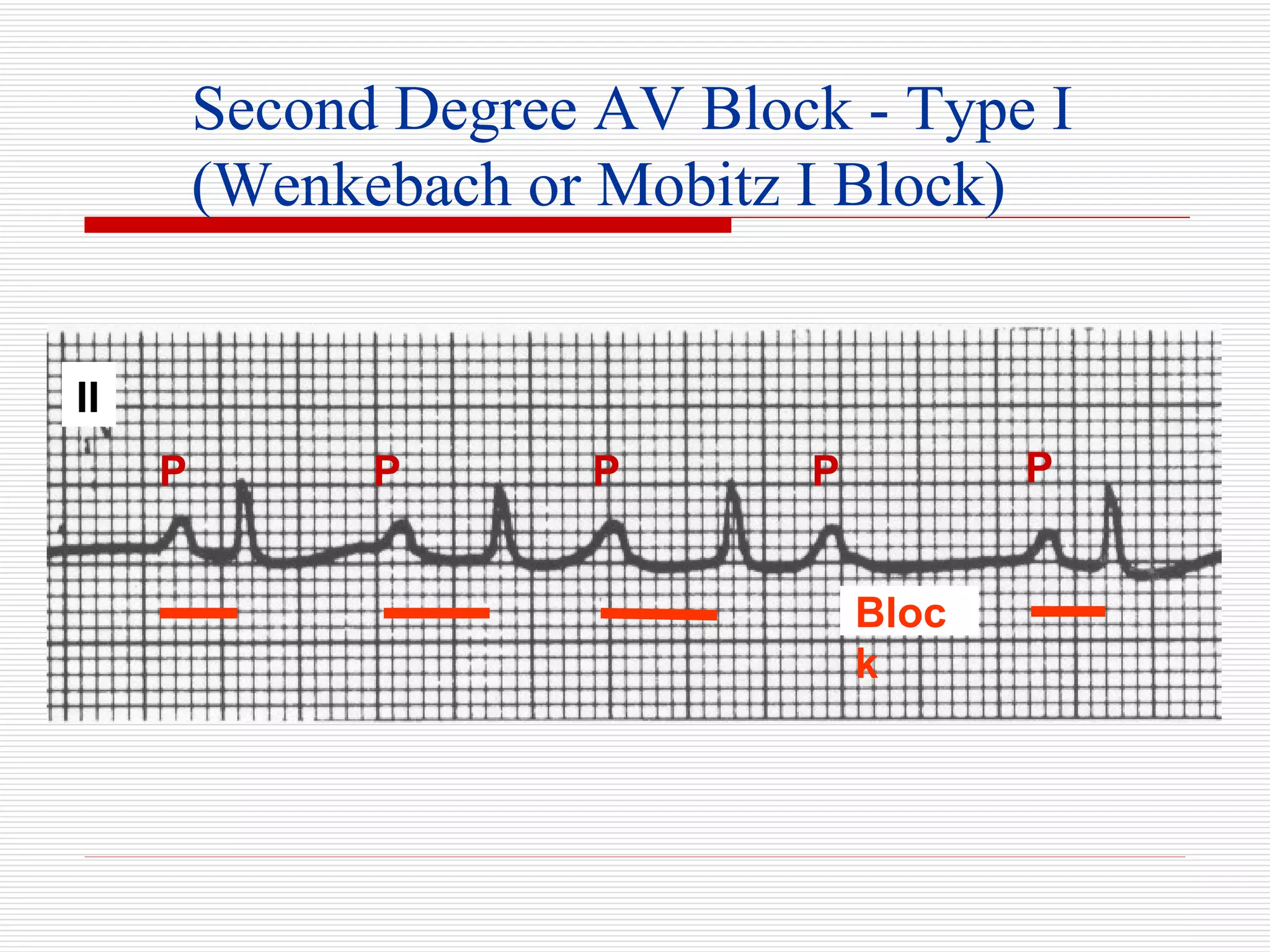 ECG: Conduction Block | PPT