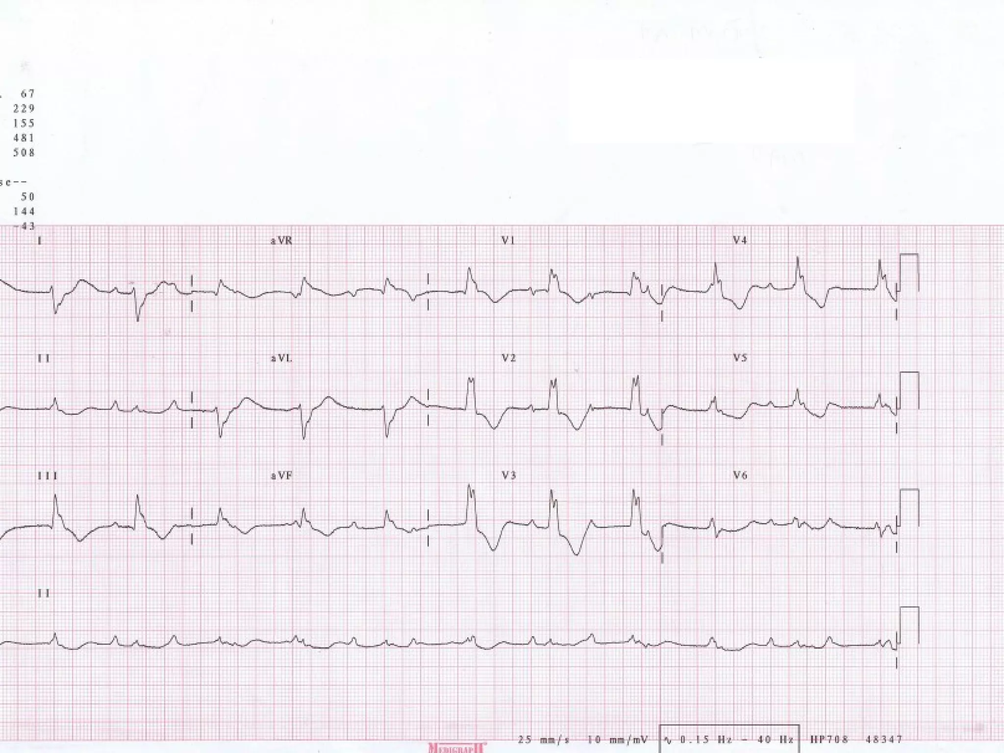 ECG: Conduction Block | PPT