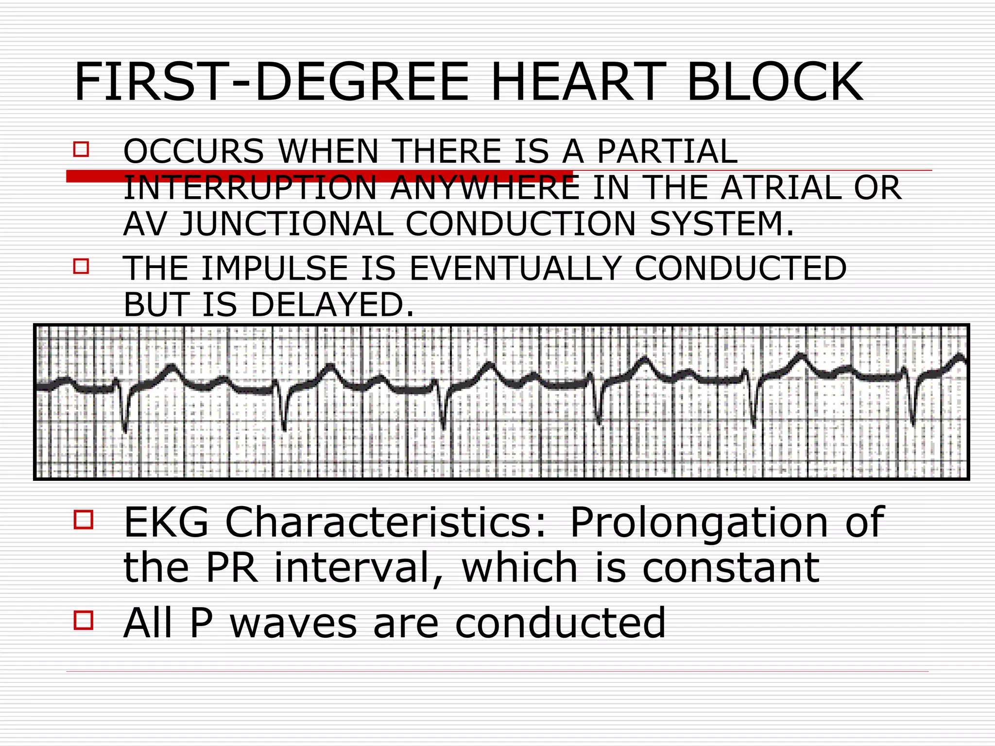 ECG: Conduction Block | PPT