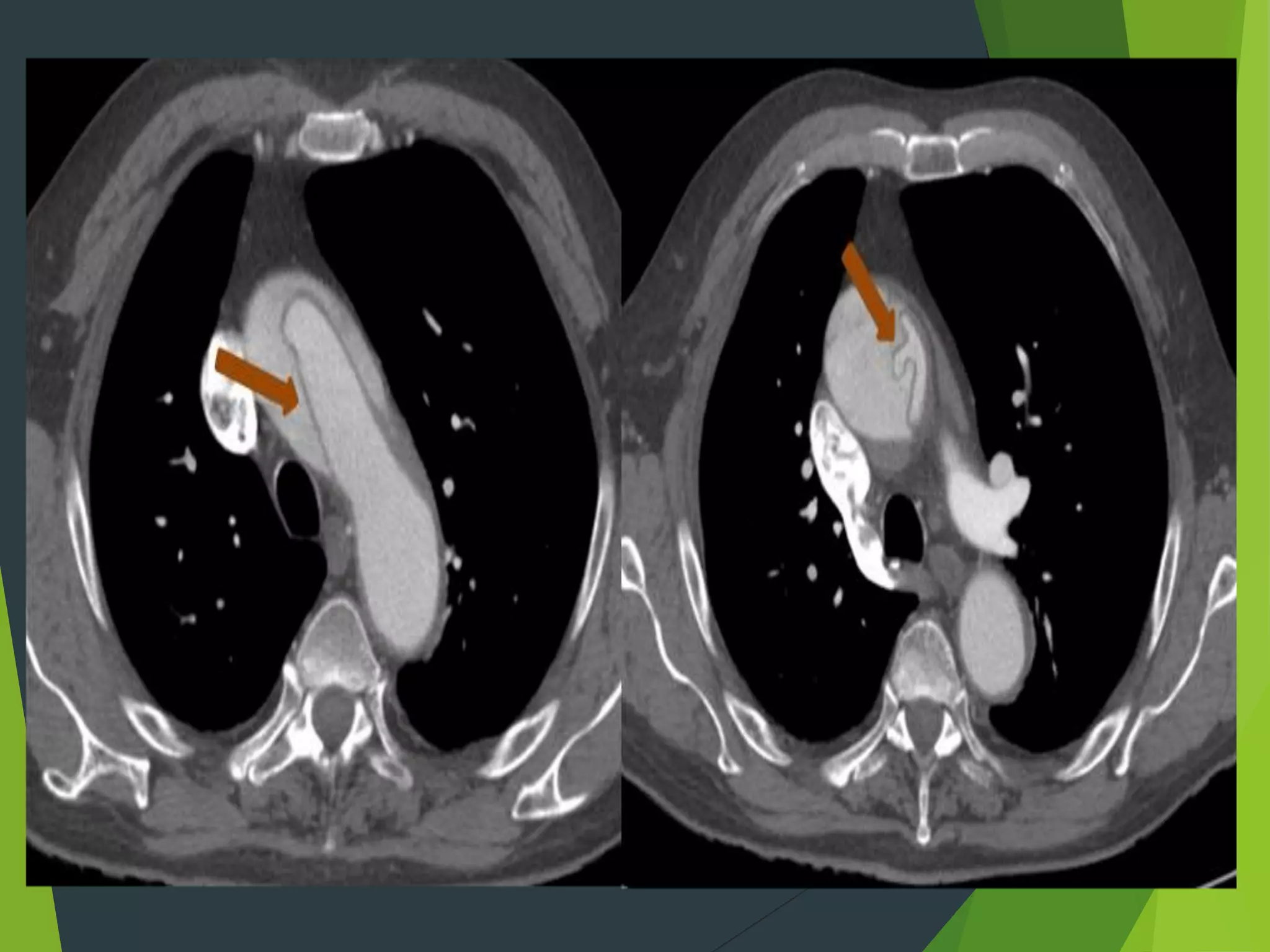 Angio tc en patologia de aorta mas frecuente en urgencias | PPTX