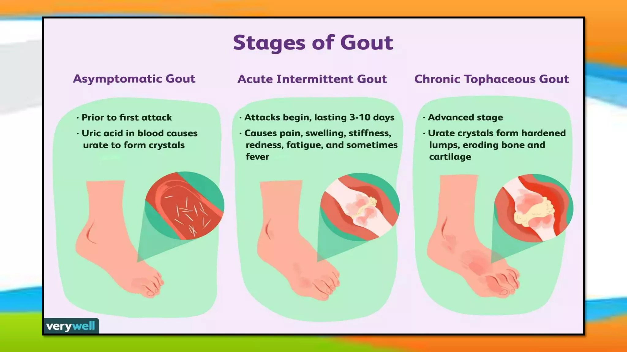 Uric acid and related Disorders | PPTX