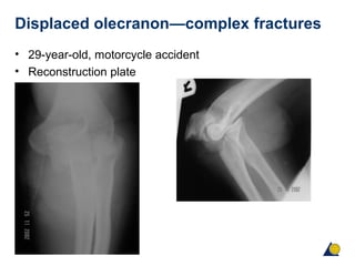 Olecranon patella | PPT