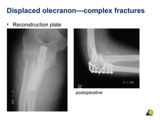 Olecranon patella | PPT