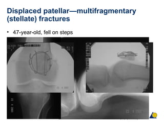 Olecranon patella | PPT