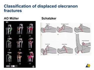 Olecranon patella | PPT