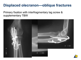 Olecranon patella | PPT