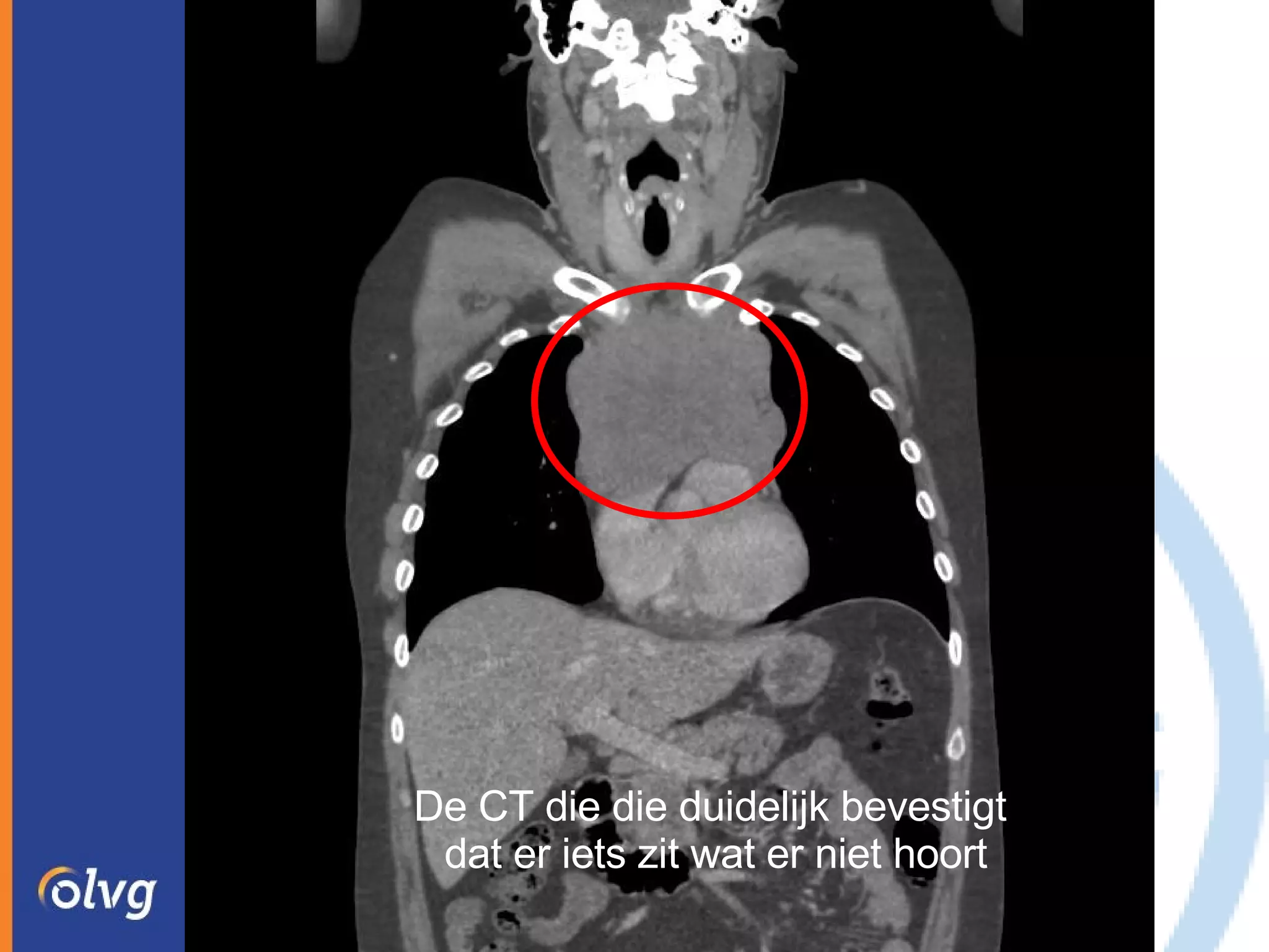 Lung Scans | PPT