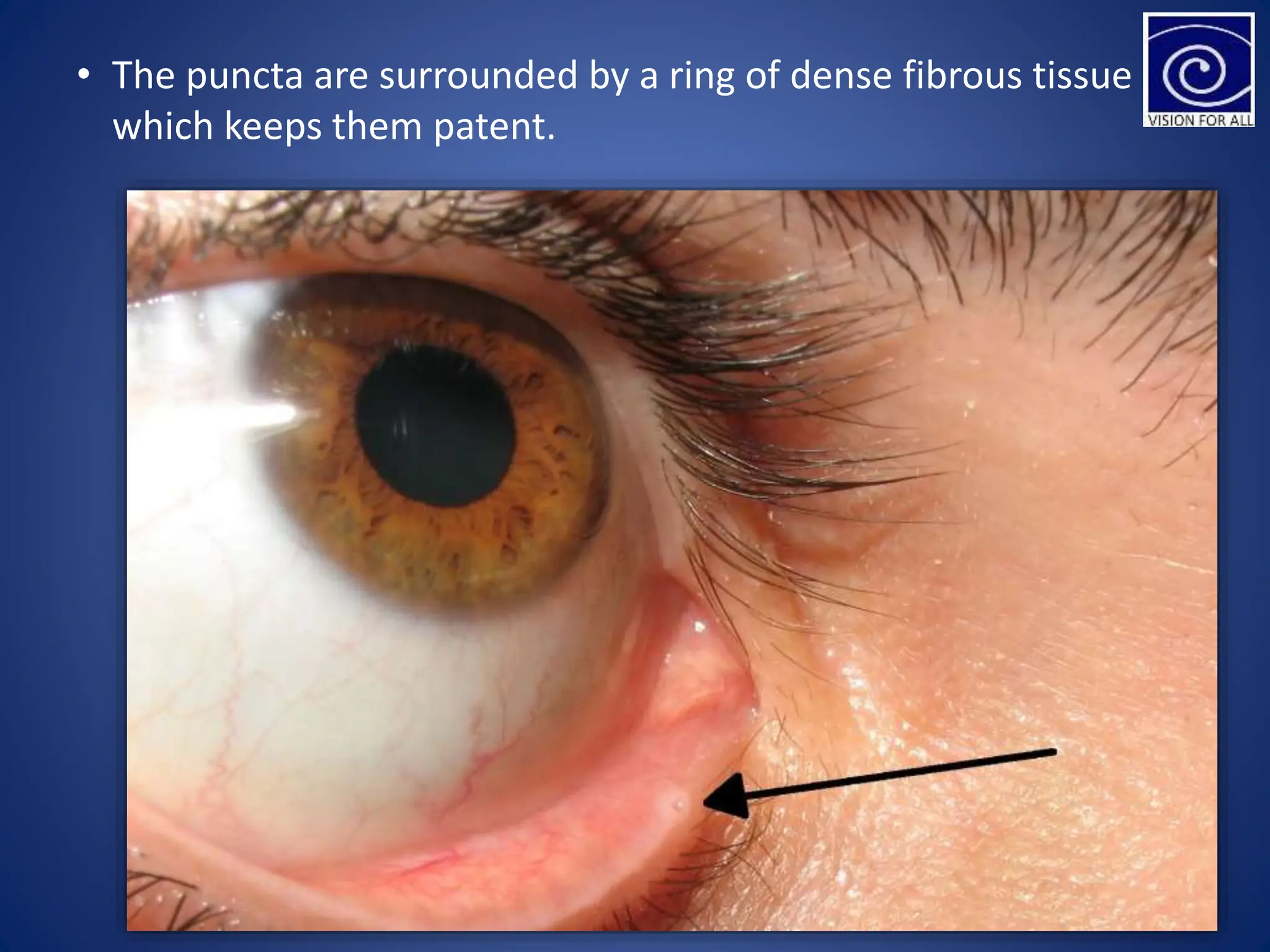 lacrimal system ppt | PPTX
