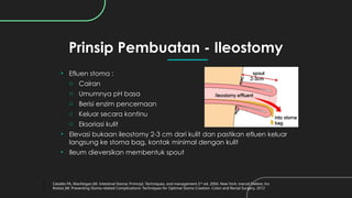 Macam-macam Stoma Intestinal dan pembuatannya.pptx