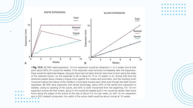 macillary transverse deficiency journal club | PPT