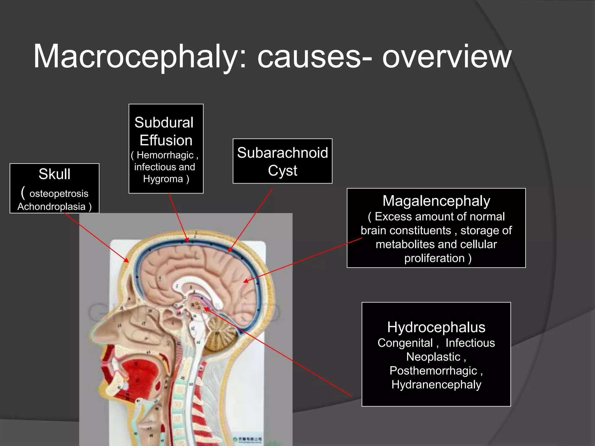 Approach to Macrocephaly / large head, Megalencephaly, Causes(Etiology ...