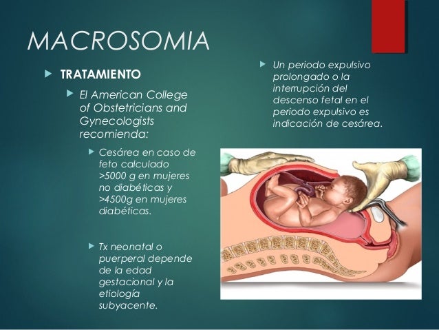 Macrosomia