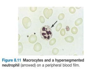 Macrocytic Hypochromic Anemia Slide Observations