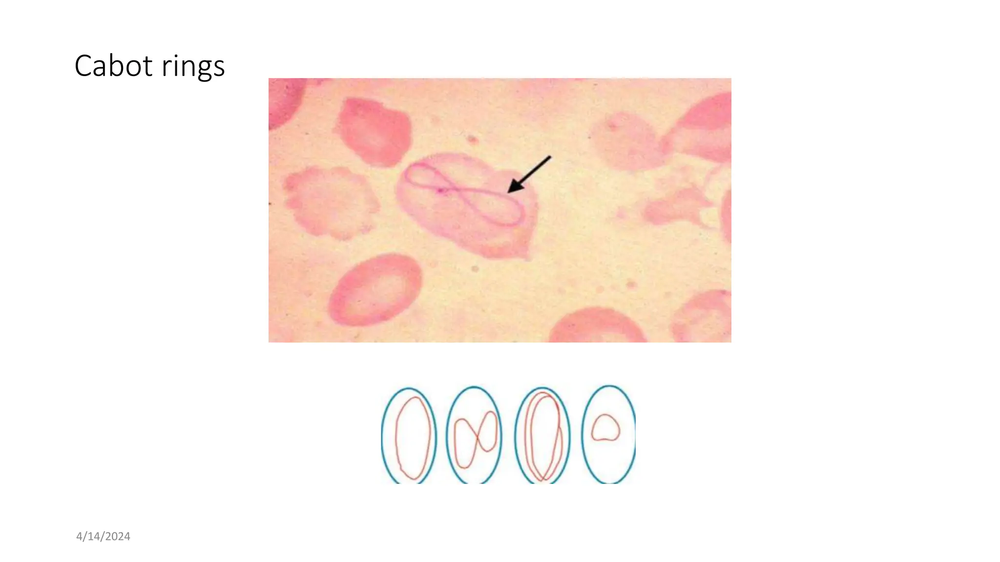 Features of megaloblastic and non megaloblastic anemia | PPTX