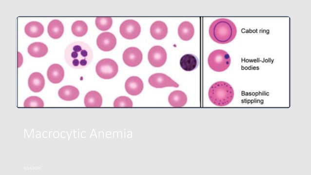 Features of megaloblastic and non megaloblastic anemia | PPTX | Blood Disorders | Diseases and ...