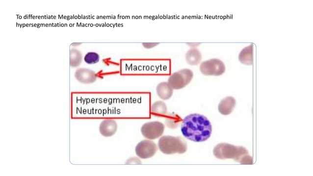 Features of megaloblastic and non megaloblastic anemia | PPTX | Blood ...
