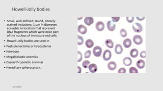Features of megaloblastic and non megaloblastic anemia | PPTX