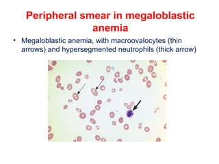 Approach to macrocytic anemia.......pptx | Blood Disorders | Diseases ...