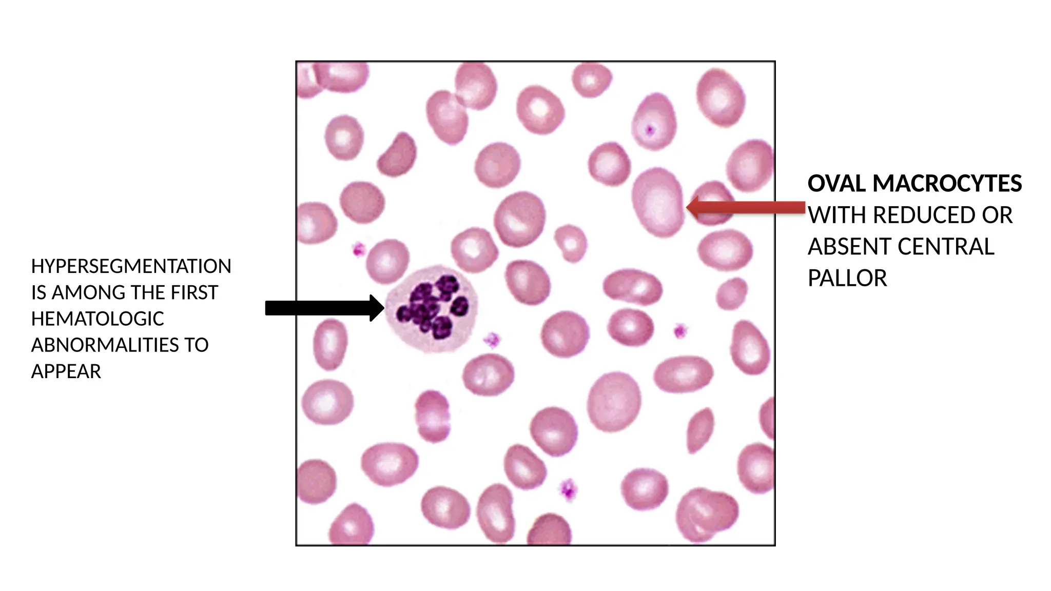 macrocytic anemia megaloblastic and nonmegaloblastic .pptx
