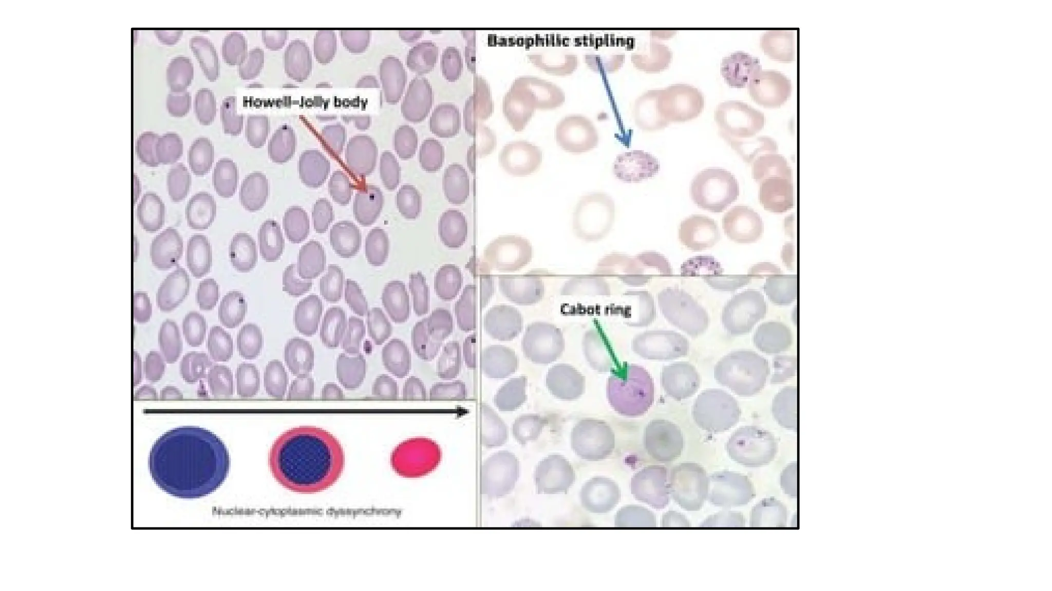macrocytic anemia megaloblastic and nonmegaloblastic .pptx