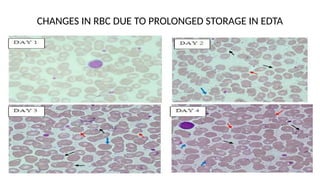 macrocytic anemia megaloblastic non megaloblastic.pptx