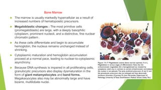 Macrocytic ANmeia.pptx