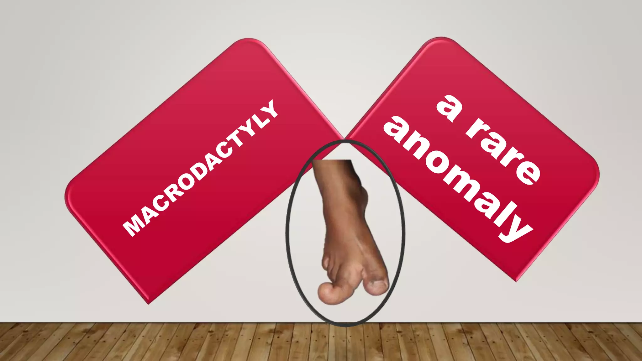 Macrodactyly A rare anomaly | PPTX