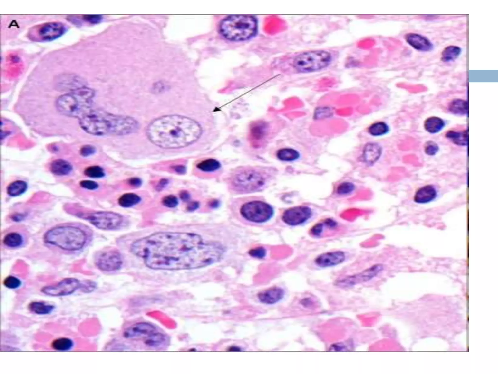 Macrophage activation syndrome | PPTX