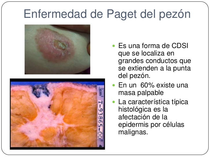 Enfermedad De Paget Del Pezon