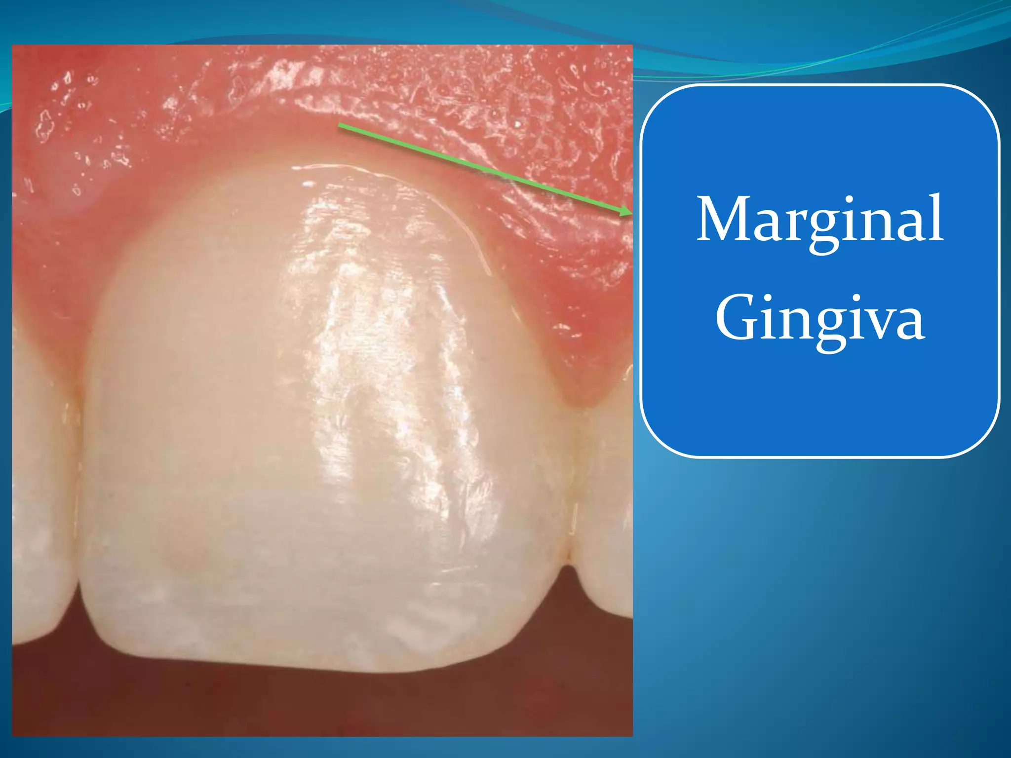 Macroscopic features of gingiva | PPTX