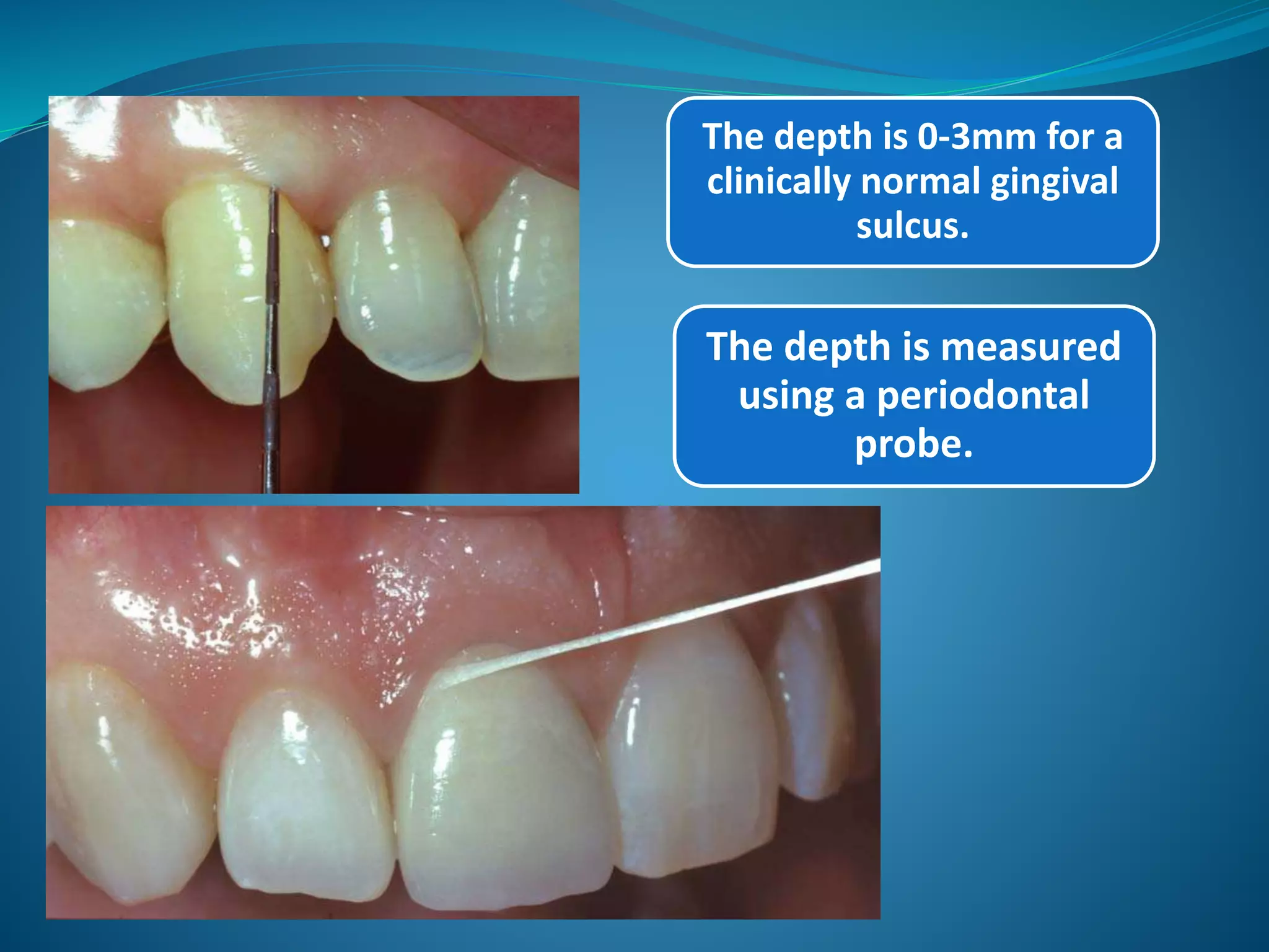 Macroscopic features of gingiva | PPTX