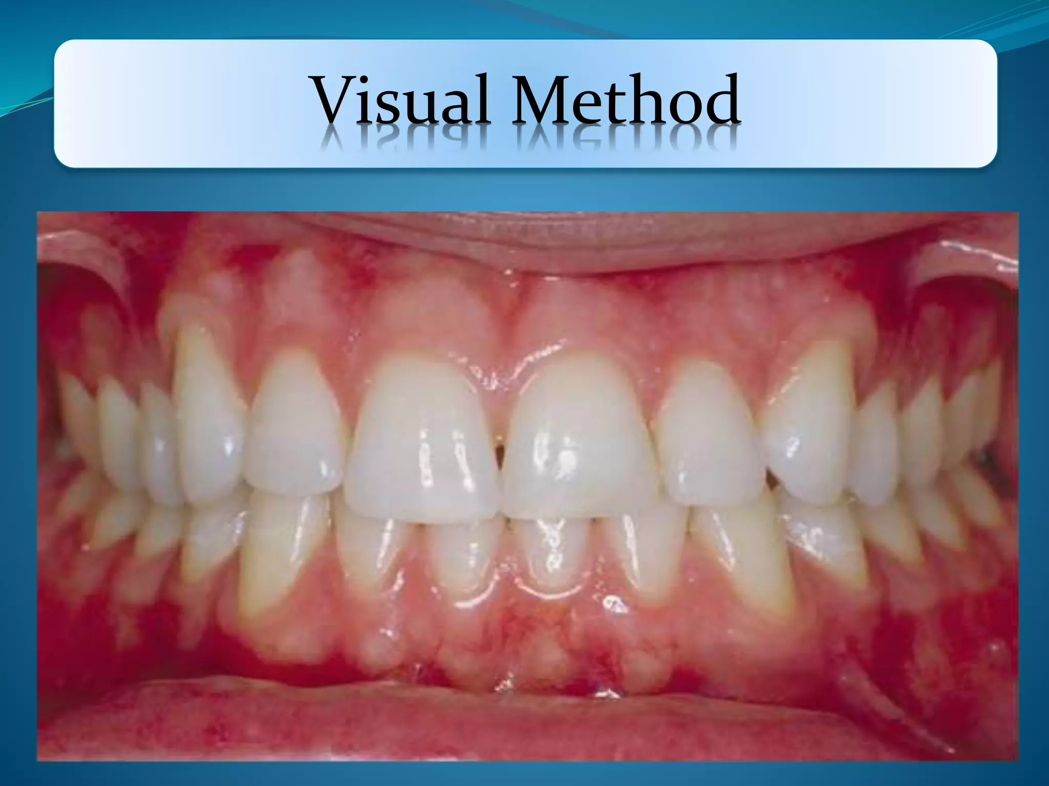 Macroscopic features of gingiva | PPTX