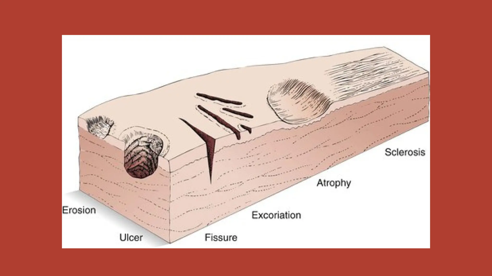 Ppt Macroscopic Structure of Skin Rash.pdf