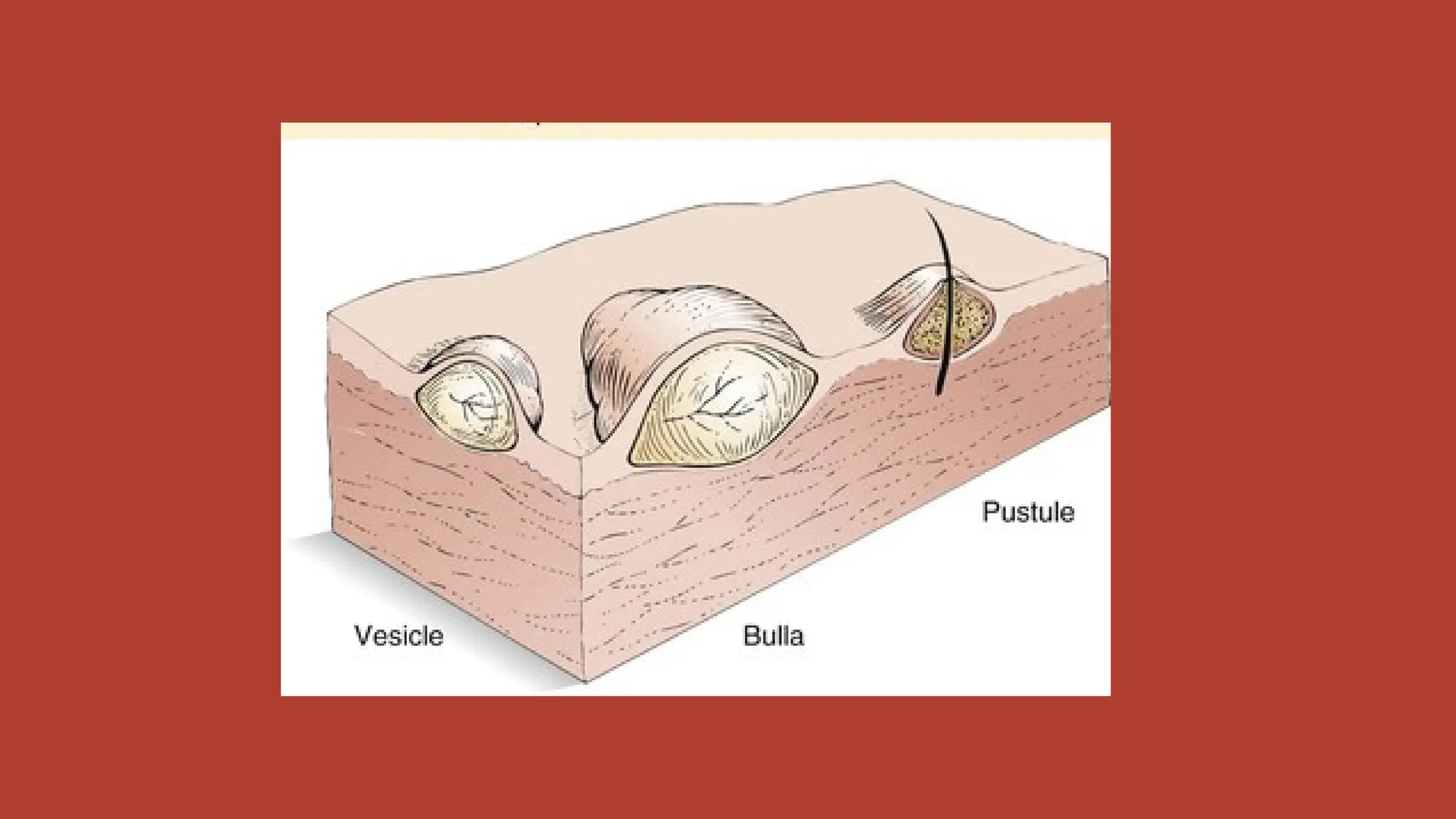 Ppt Macroscopic Structure of Skin Rash.pdf