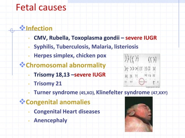 Macrosomia and iugr with case study for undergraduare | PPSX ...