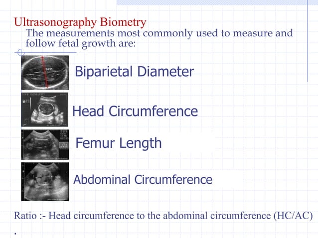 Macrosomia and iugr with case study for undergraduare | PPSX ...