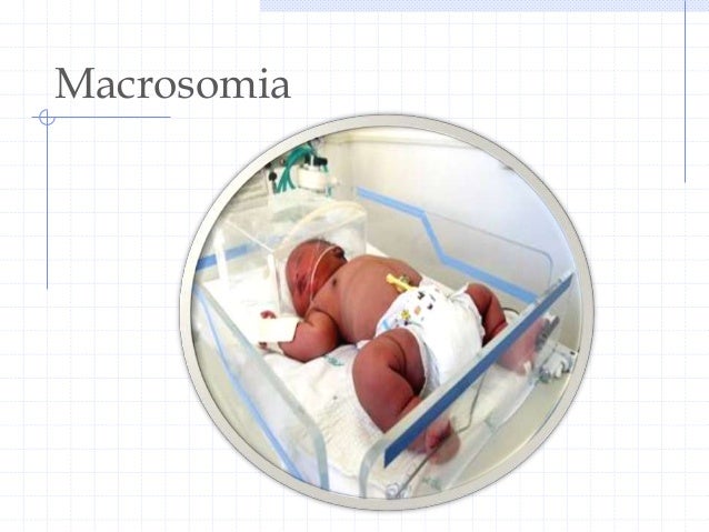 Macrosomia and iugr with case study for undergraduare