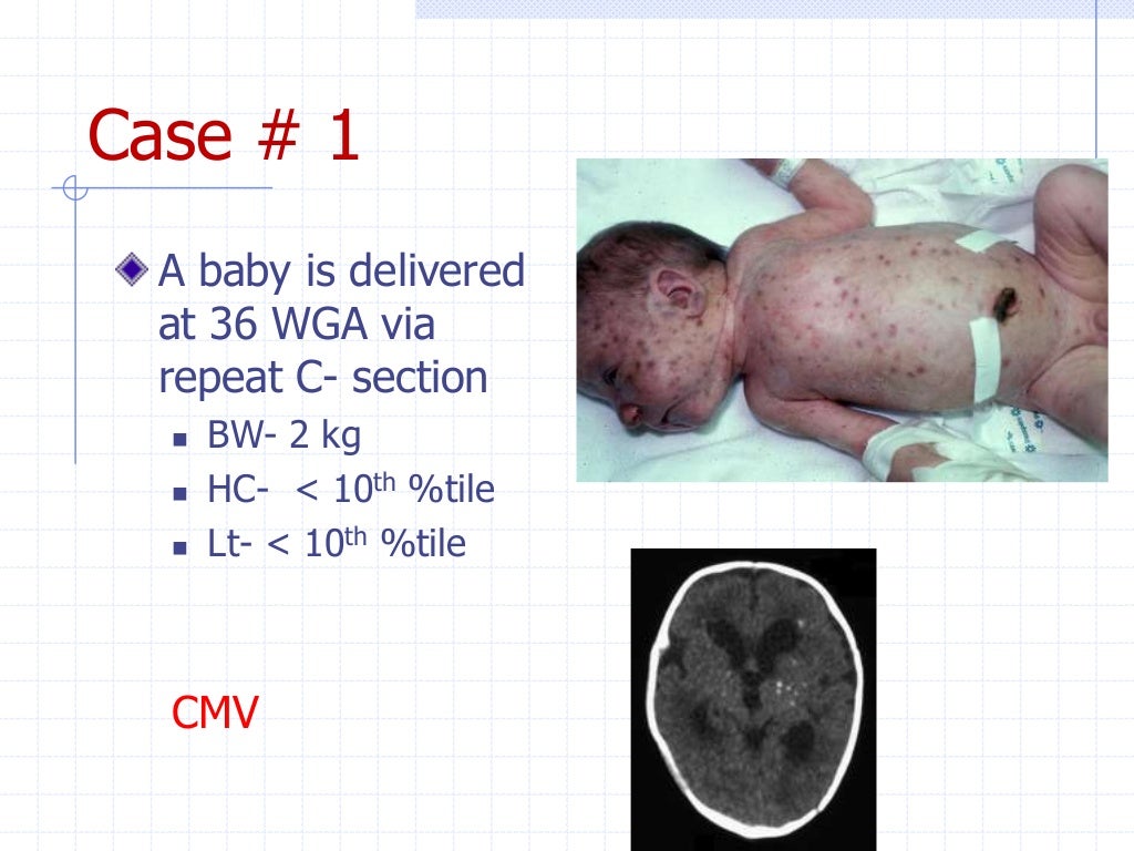 Macrosomia and iugr with case study for undergraduare