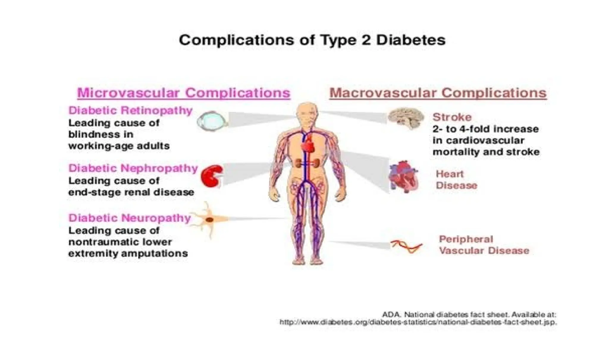 Macrovascular complications of diabetes mellitus | PPTX