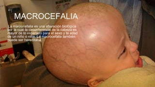 macro y microcefalia | PPTX