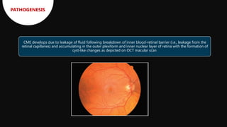 MACULAR DISORDERS POWERPOINT PRESENTATION | PPTX