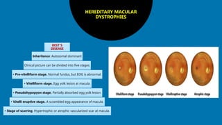 MACULAR DISORDERS POWERPOINT PRESENTATION | PPTX